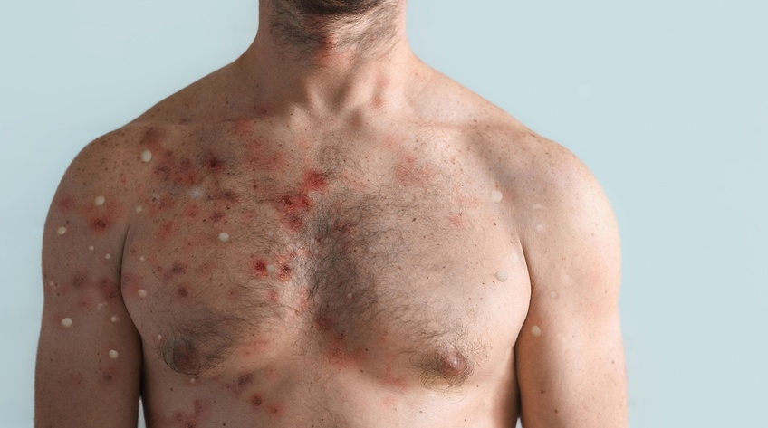 Apkoppor kan smitta före symtom, enligt ny studie