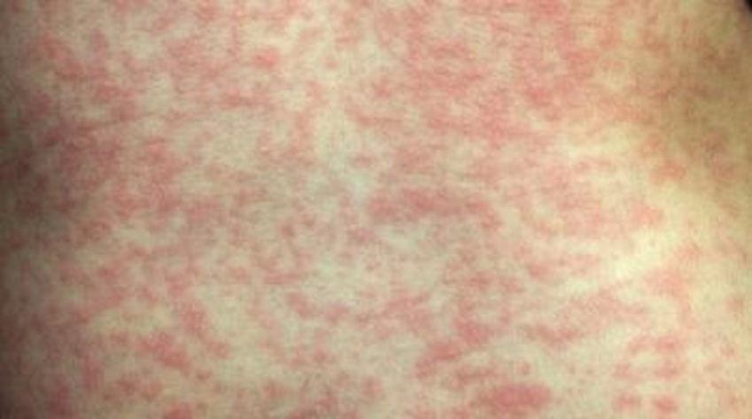 Mässling mycket farligare än man trott