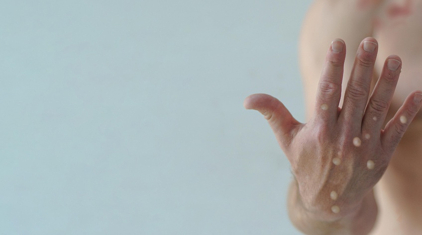 Första studien om apkoppor hos kvinnor visar delvis andra smittvägar